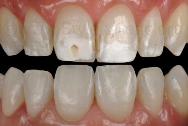 Icon Resin Infiltration – Jasbir Orthodontic and Dental Specialist Centre
